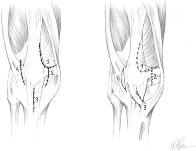 Preliminary results of two surgical techniques in the treatment of ...