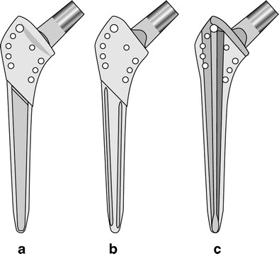 Radiological identification of Zweymüller-type femoral stem prosthesis ...