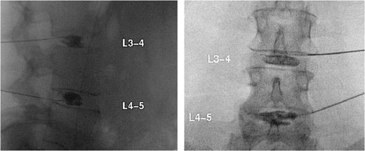 Intradiscal platelet-rich plasma (PRP) injections for discogenic low ...