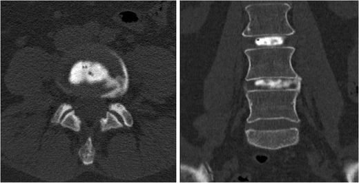 Intradiscal platelet-rich plasma (PRP) injections for discogenic low ...
