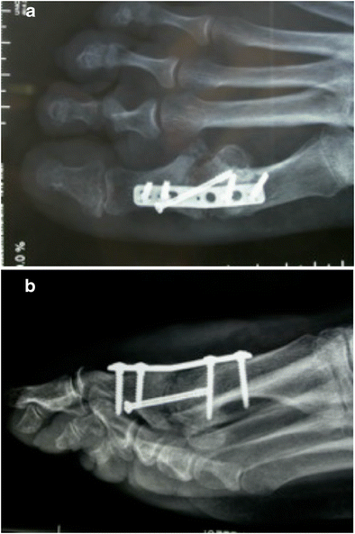 Long-term outcome of first metatarsophalangeal joint fusion in the ...