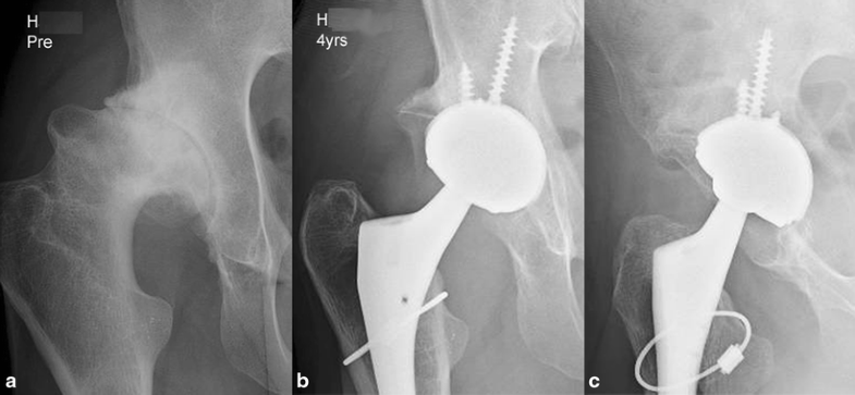 Early experience with dual mobility acetabular systems featuring highly ...