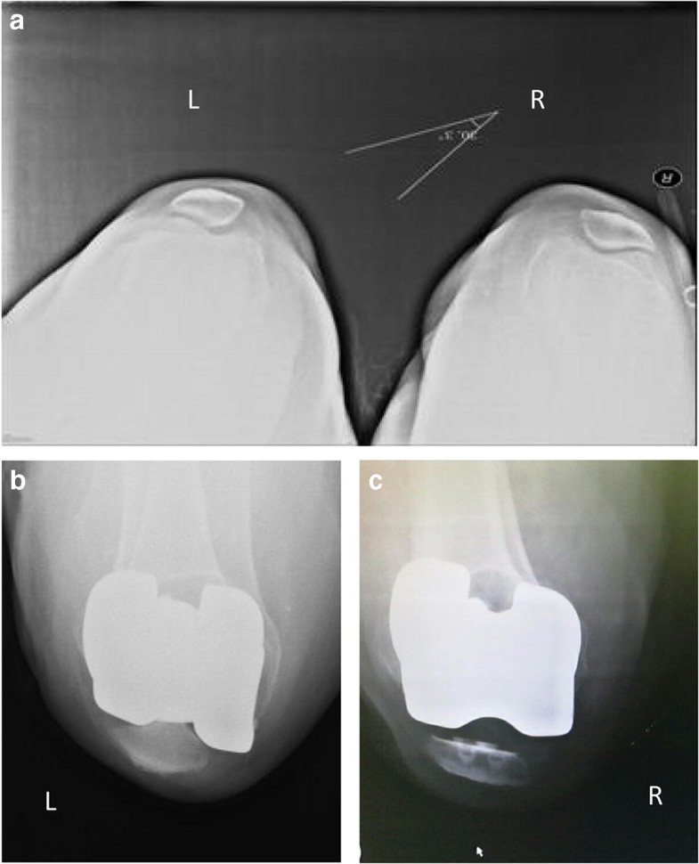Resurfacing versus not-resurfacing the patella in one-stage bilateral ...