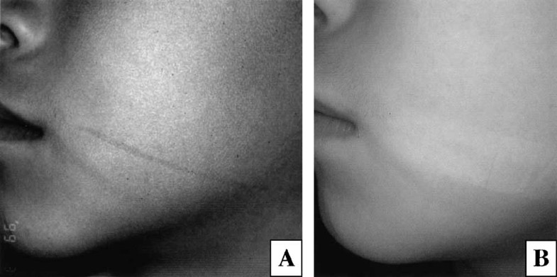 Pulsed Dye Laser Treatment for Linear Scars with Concave and ...