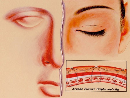 Celebrity Arcade Suture Blepharoplasty for Double Eyelid | SpringerLink