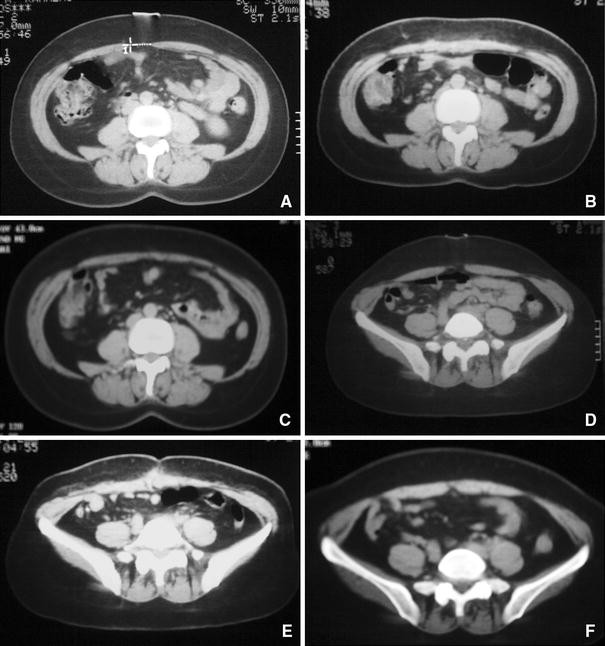 Rectus Diastasis Corrected with Absorbable Suture: A Long-Term ...