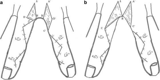 Dorsal Pentagonal Local Flap: A New Technique of Web Reconstruction for ...