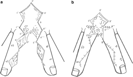 Dorsal Pentagonal Local Flap: A New Technique of Web Reconstruction for ...