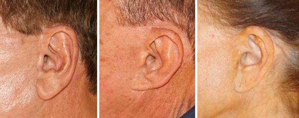 Preauricular Incision Outlining During a Face-Lift: A Step-by-Step ...