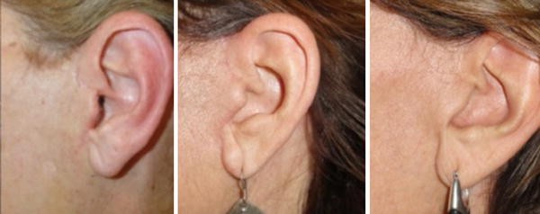 Preauricular Incision Outlining During a Face-Lift: A Step-by-Step ...