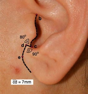 Preauricular Incision Outlining During a Face-Lift: A Step-by-Step ...