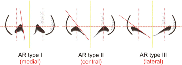 New Classification for Correction of Alar Retraction Using the Alar ...