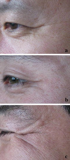 Analysis of the Patterns of Lateral Canthal Rhytids and Reference for ...