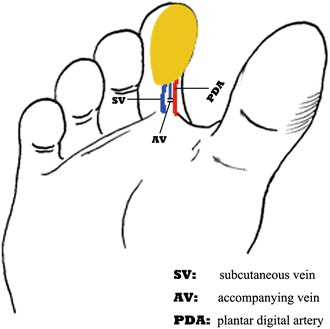 Digital Pulp Reconstruction with Free Neurovascular Toe Flaps ...