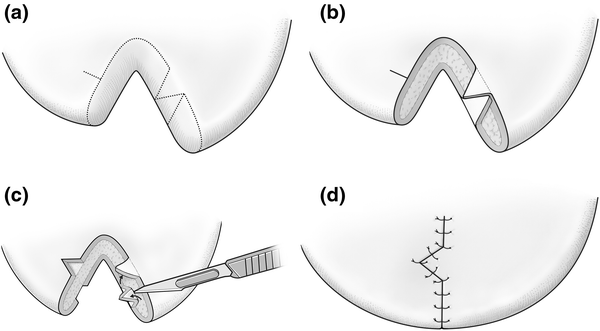Traumatic Cleft Earlobe Repair: Using a Double Triangular Flap for ...