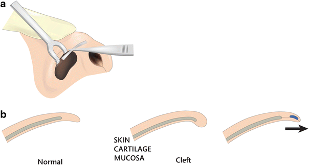 The Correction of Alar–Columella Web Deformities in Unilateral Cleft ...
