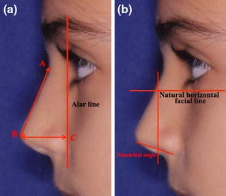 Effect of the Depressor Septi Nasi Muscle Modification on Nasal Tip ...