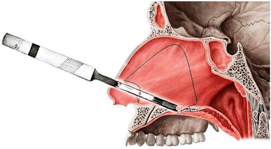 Palatal Perforation as a Rare Complication of Nasal Septoplasty ...