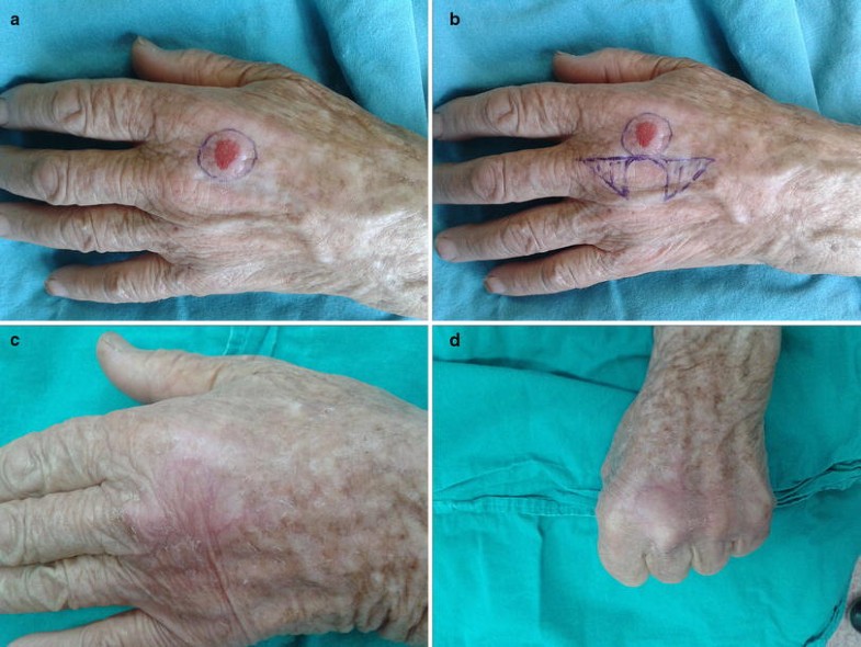 Omega (Ω) Advancement Flap: A Circular Flap Design for the Aesthetic ...