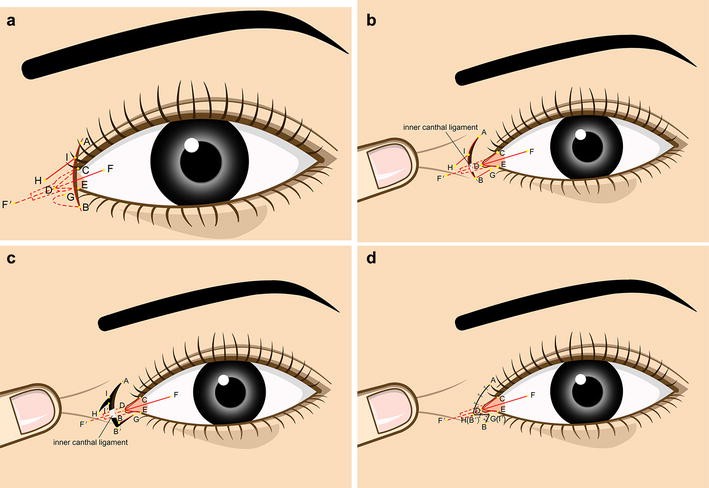 Epicanthoplasty with Epicanthal Dermatic Tension-Releasing Incision ...