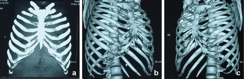 Aesthetic Auricular Reconstruction in Adult Patients with Rib Cartilage ...