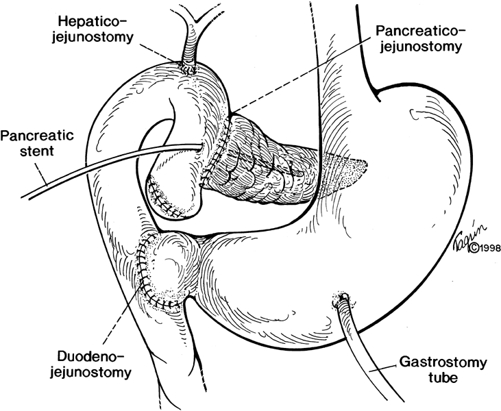 Pylorus-preserving Pancreaticoduodenectomy in the Treatment of Chronic Pancreatitis | SpringerLink
