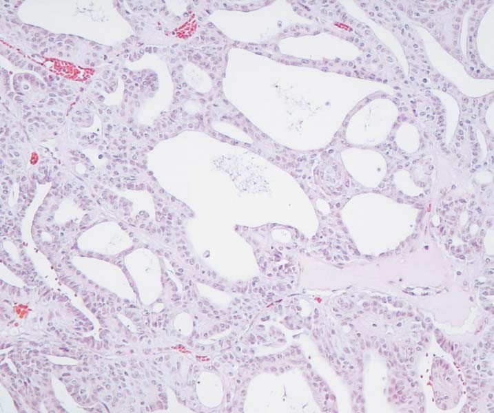 Cribriform-morular variant of Papillary Thyroid Carcinoma: Clue to ...
