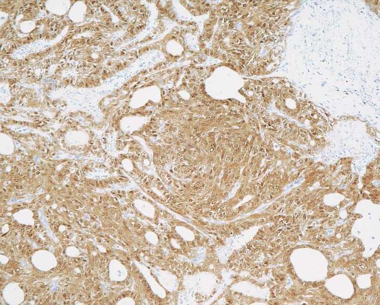 Cribriform-morular variant of Papillary Thyroid Carcinoma: Clue to ...