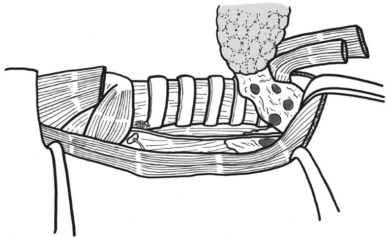 Modified Radical Neck Dissection for Differentiated Thyroid Cancer ...