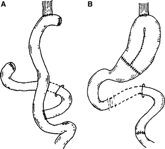 Proximal Gastrectomy Reconstructed by Jejunal Pouch Interposition for ...