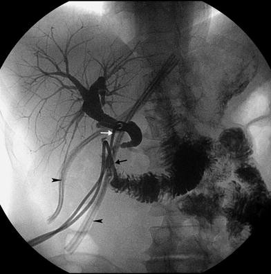 A Life-saving but Inadequately Discussed Procedure: Tube Duodenostomy ...