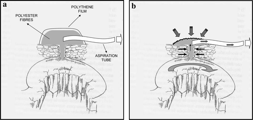 Treatment of High-output Enterocutaneous Fistulas with a Vacuum ...