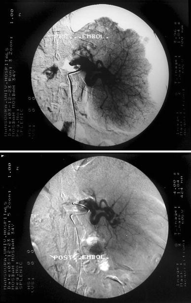 Partial Splenic Embolization Versus Splenectomy for the Management of ...