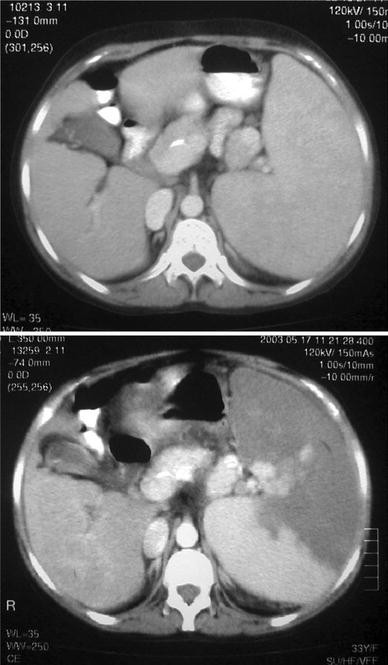 Partial Splenic Embolization Versus Splenectomy for the Management of ...