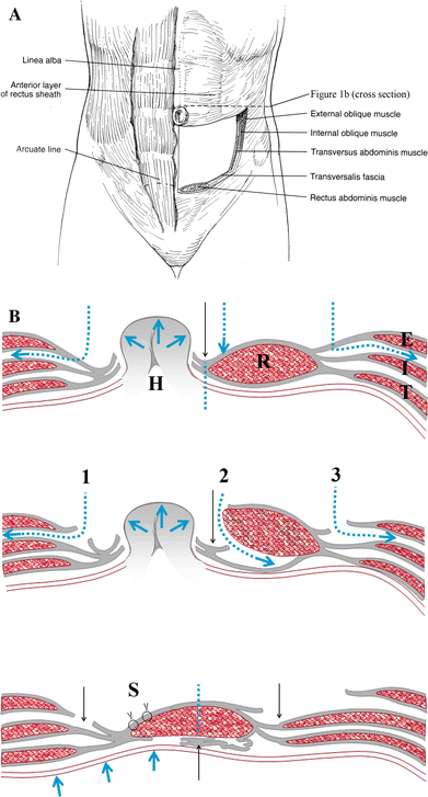 Tensiometry as a Decision Tool for Abdominal Wall Reconstruction with ...