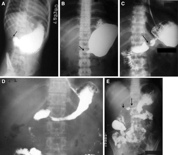 Chronic Corrosive Injuries of the Stomach—A Single Unit Experience of ...