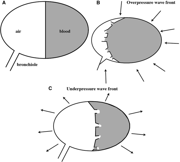 Primary Blast Injuries—An Updated Concise Review | SpringerLink