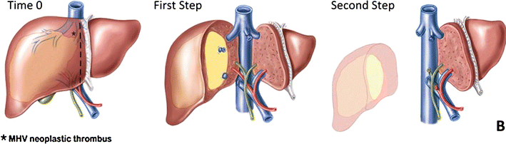 The ALPPS Procedure: A Surgical Option for Hepatocellular Carcinoma ...