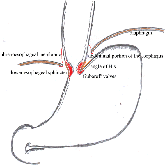 Pathophysiology of Gastroesophageal Reflux Disease | SpringerLink