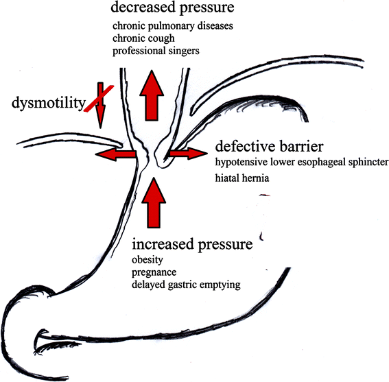 Pathophysiology of Gastroesophageal Reflux Disease | SpringerLink