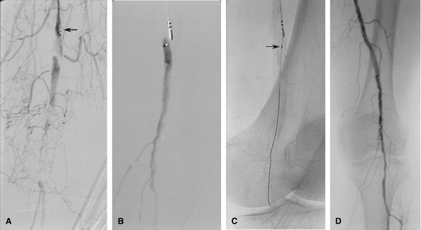 The Outback Catheter: A New Device for True Lumen Re-entry After ...