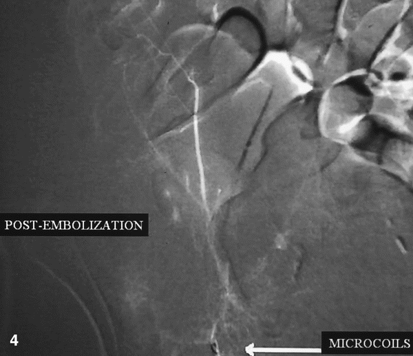 Transcatheter Arterial Embolization of Concurrent Spontaneous Hematomas ...
