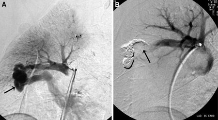 Onyx, a New Liquid Embolic Material for Peripheral Interventions ...