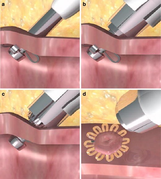 StarClose Vascular Closure Device: Prospective Study on 222 Deployments ...