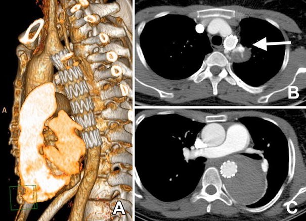 Second-Generation Amplatzer Vascular Plug (AVP) for the Treatment of ...