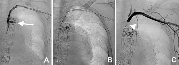 Second-Generation Amplatzer Vascular Plug (AVP) for the Treatment of ...
