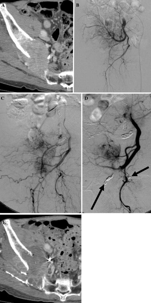 Transcatheter Arterial Chemoembolization (TACE) or Embolization (TAE ...