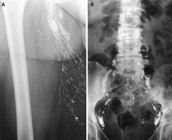 Lymphangiography in the Diagnosis and Localization of Various Chyle ...
