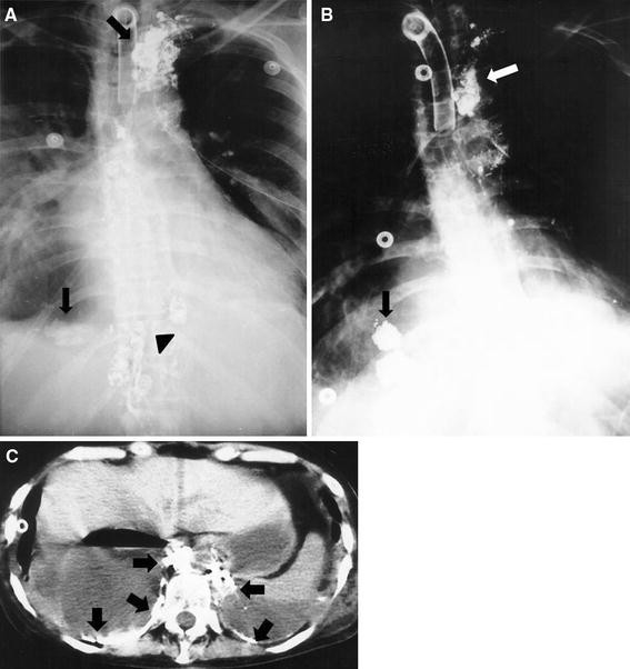 Lymphangiography in the Diagnosis and Localization of Various Chyle ...