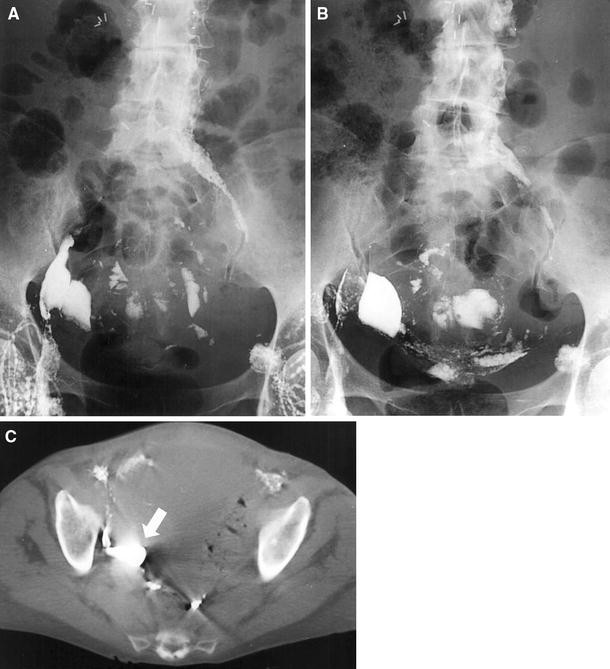 Lymphangiography in the Diagnosis and Localization of Various Chyle ...